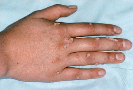 Overview of Warts