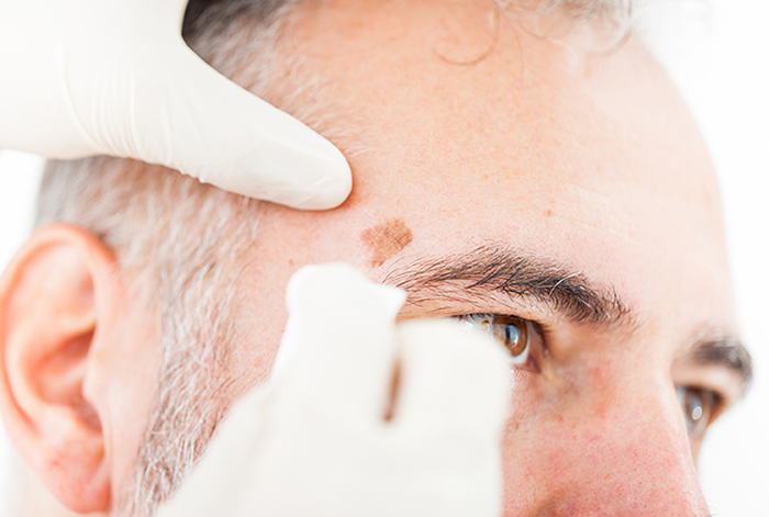 5 Effective Home Remedies For Solar Lentigo